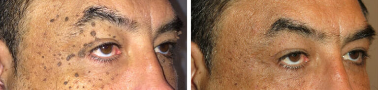 Eyelid Skin Tag Removal London | London Dermatology Clinic