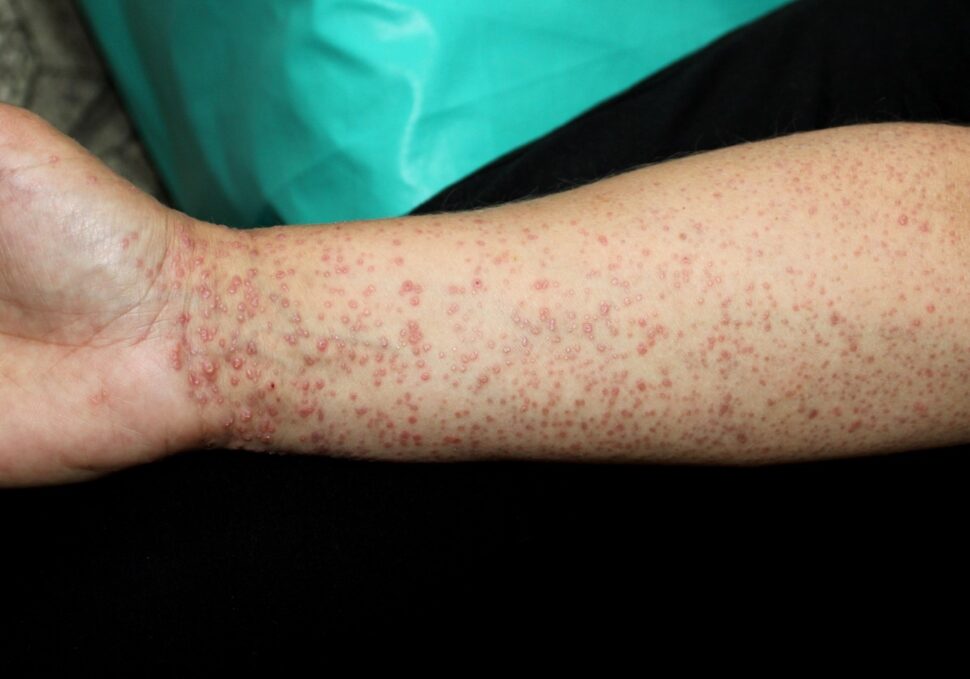 chronic-inflammatory-skin