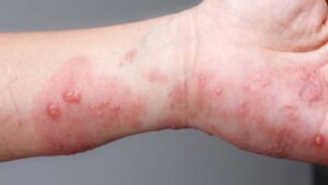 Scabies | Londondermatologyclinics.com