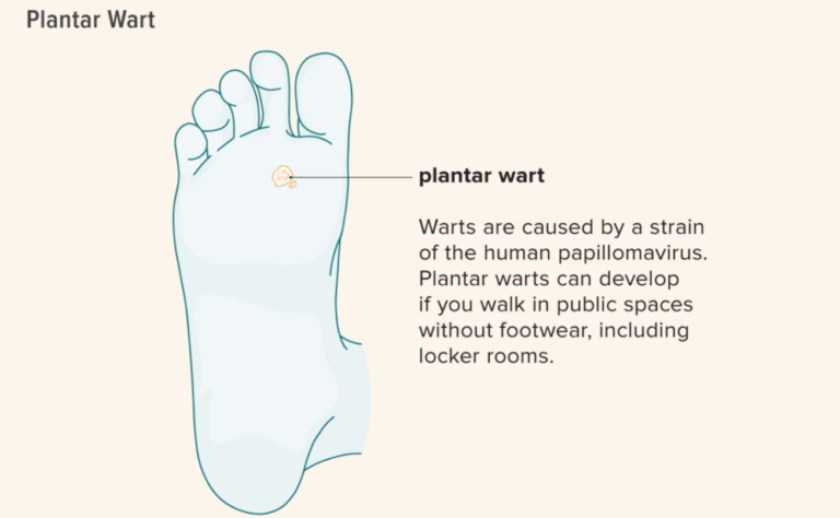 Plantar Wart Treatment at Home - Approved Removal Methods