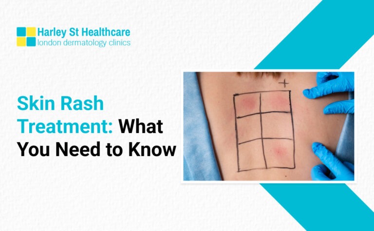 Skin Rash Treatment in London: Causes, Care & Advice